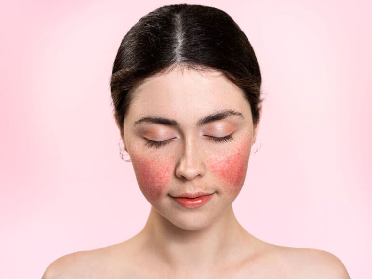 How To Fix Red Skin With Photoshop In Less Than A Minute InFocus how-to-fix-red-skin-with-photoshop-in-less-than-a-minute-infocus